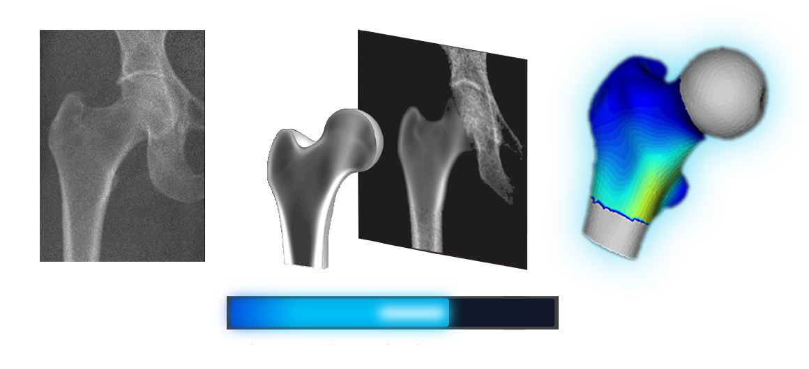 3D-SHAPER 3D-DXA: cortical and trabecular bone from DXA