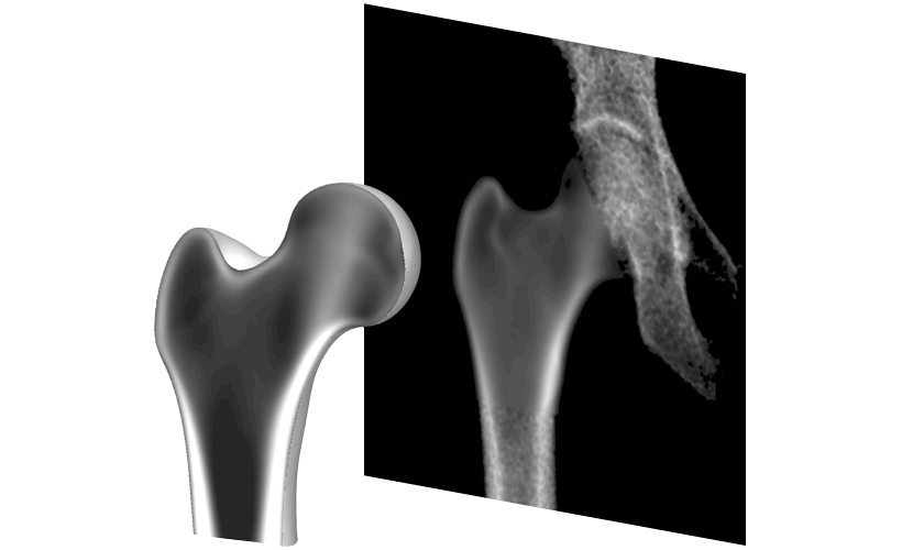 3D-SHAPER 3D-DXA: cortical and trabecular bone from DXA